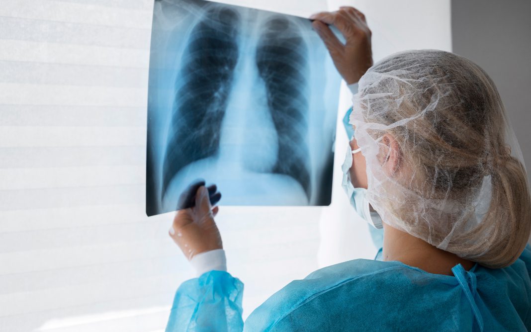 OMS: Tuberculose Mata Milhões Anualmente, Alerta Relatório